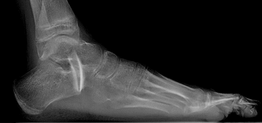 Piciorul plat (platfusul) la copil si adolescent – Herdea.ro – Portal ...