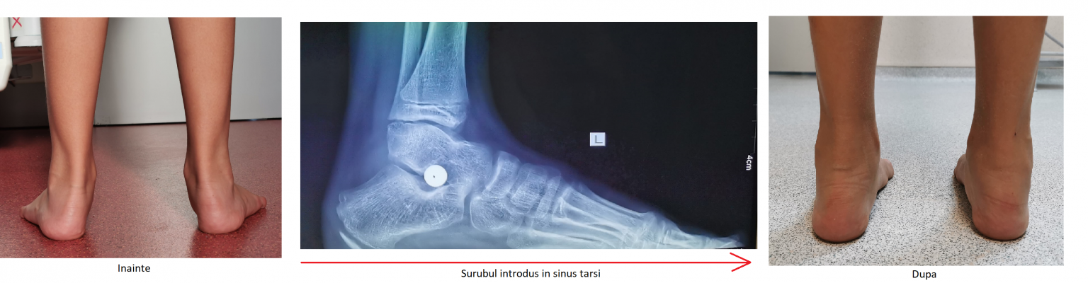 Artroerezis – tratamentul chirurgical minim invaziv al piciorului plat ...