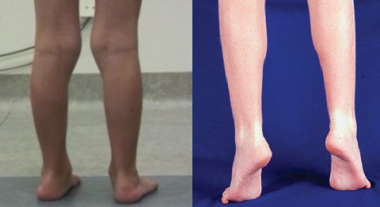 Piciorul plat (platfusul) la copil si adolescent – Herdea.ro – Portal ...